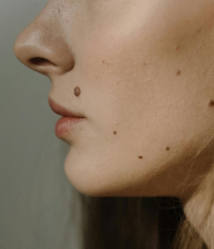 Double Chin: Causes, Prevention & Treatment | Dr Hass Clinic