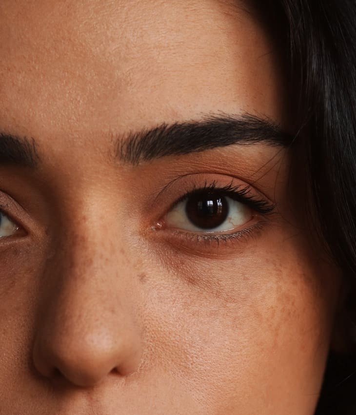 Best Eye Bags Treatment London | Dr Hass Facial Aeshtetics