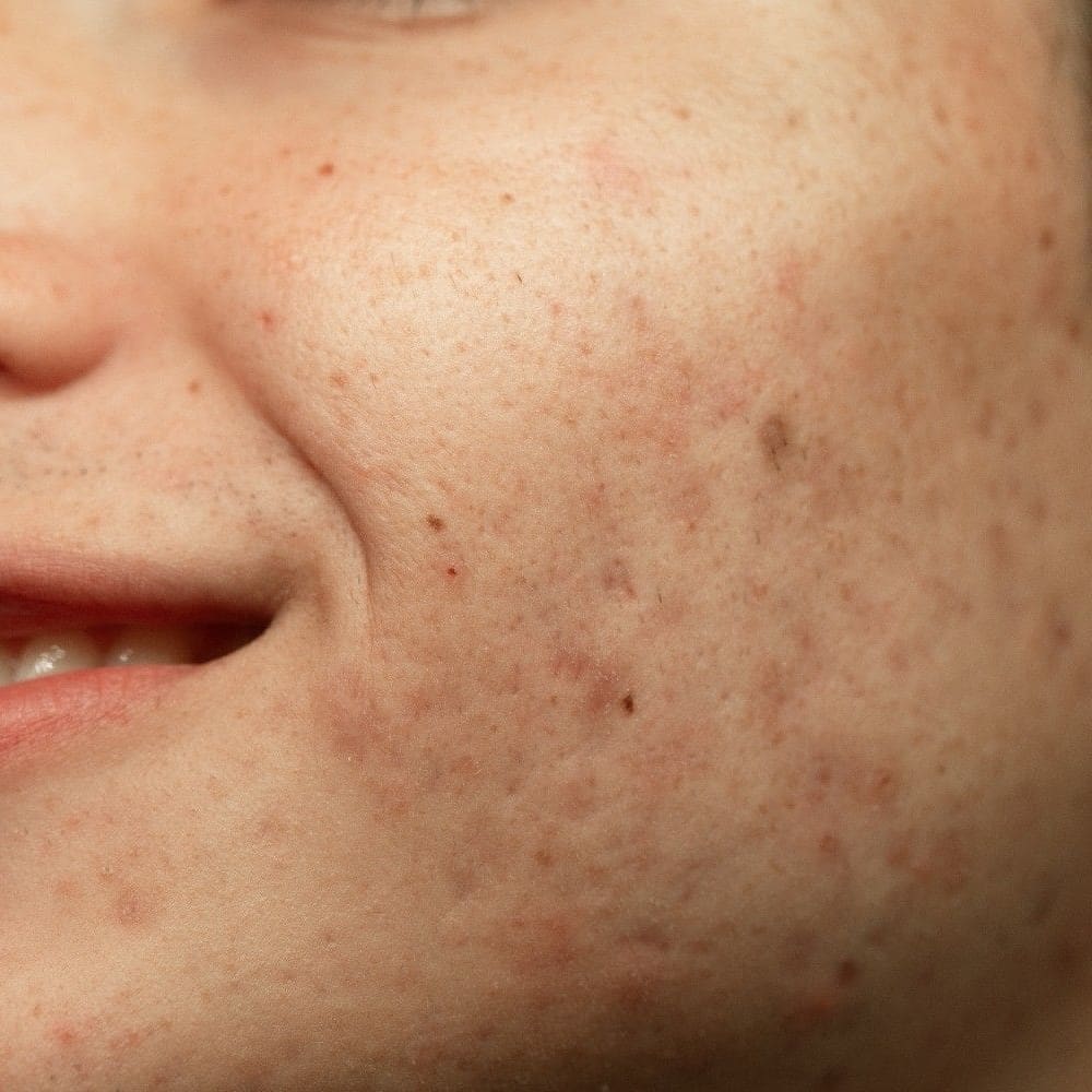 Pigmentation: Causes, Prevention and Treatment | Dr Hass Clinic