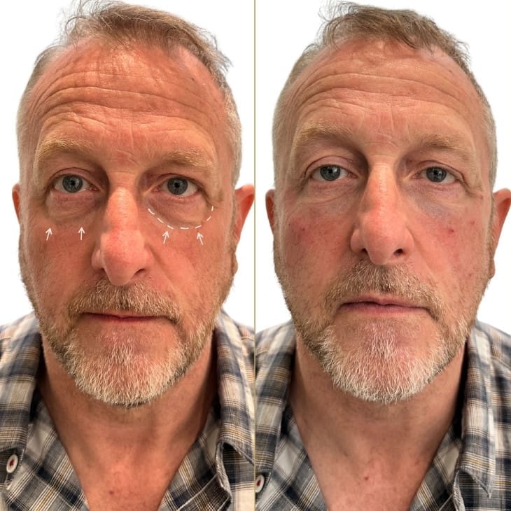 Tear Trough Filler Aftercare & Swelling Timeline: What to Expect | Dr ...